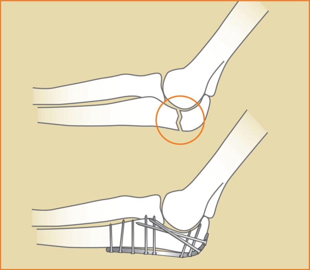 Παθησεις Αγκωνα - www.flevarakis.gr